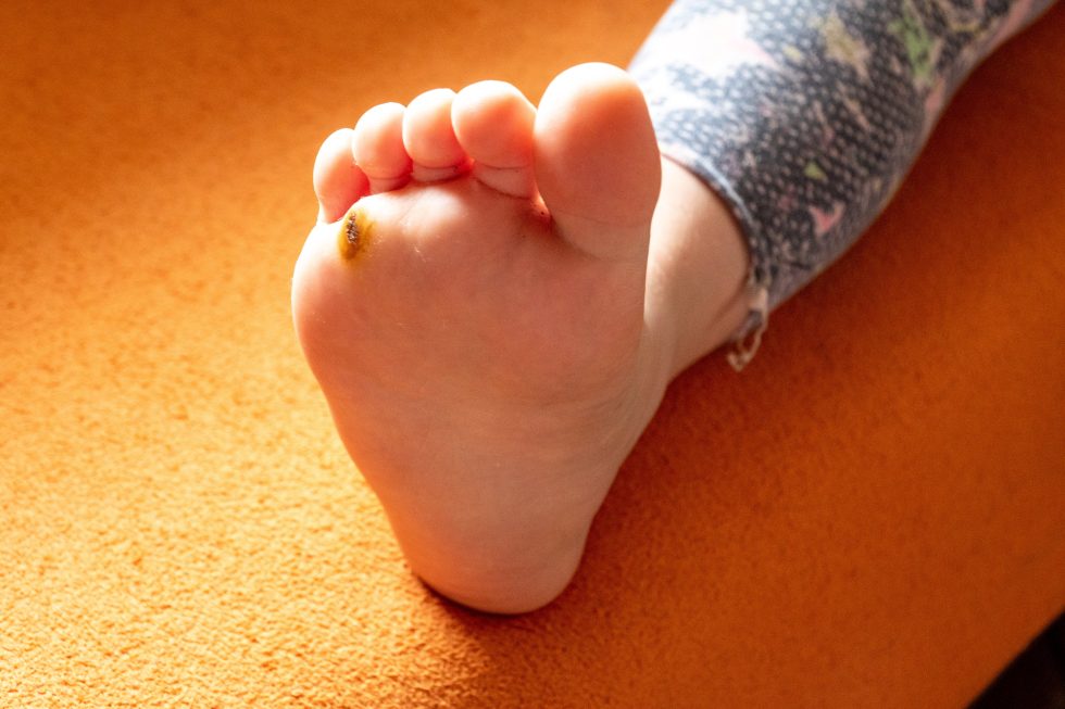 Verrucae Treatment - Cutting Edge Podiatry