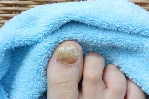 Difficult and Thickened Toenails - Cutting Edge Podiatry