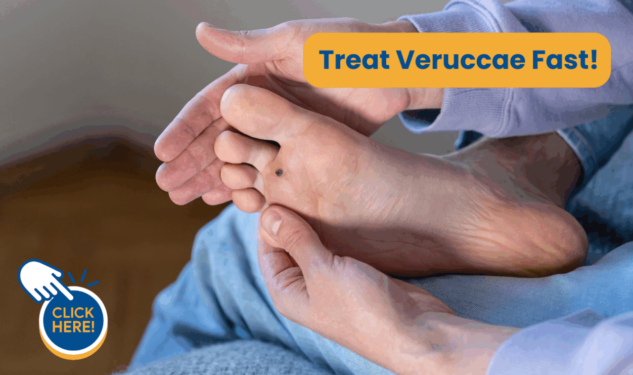 How to Prevent Verrucae and What to Do if You Get One - Cutting Edge ...