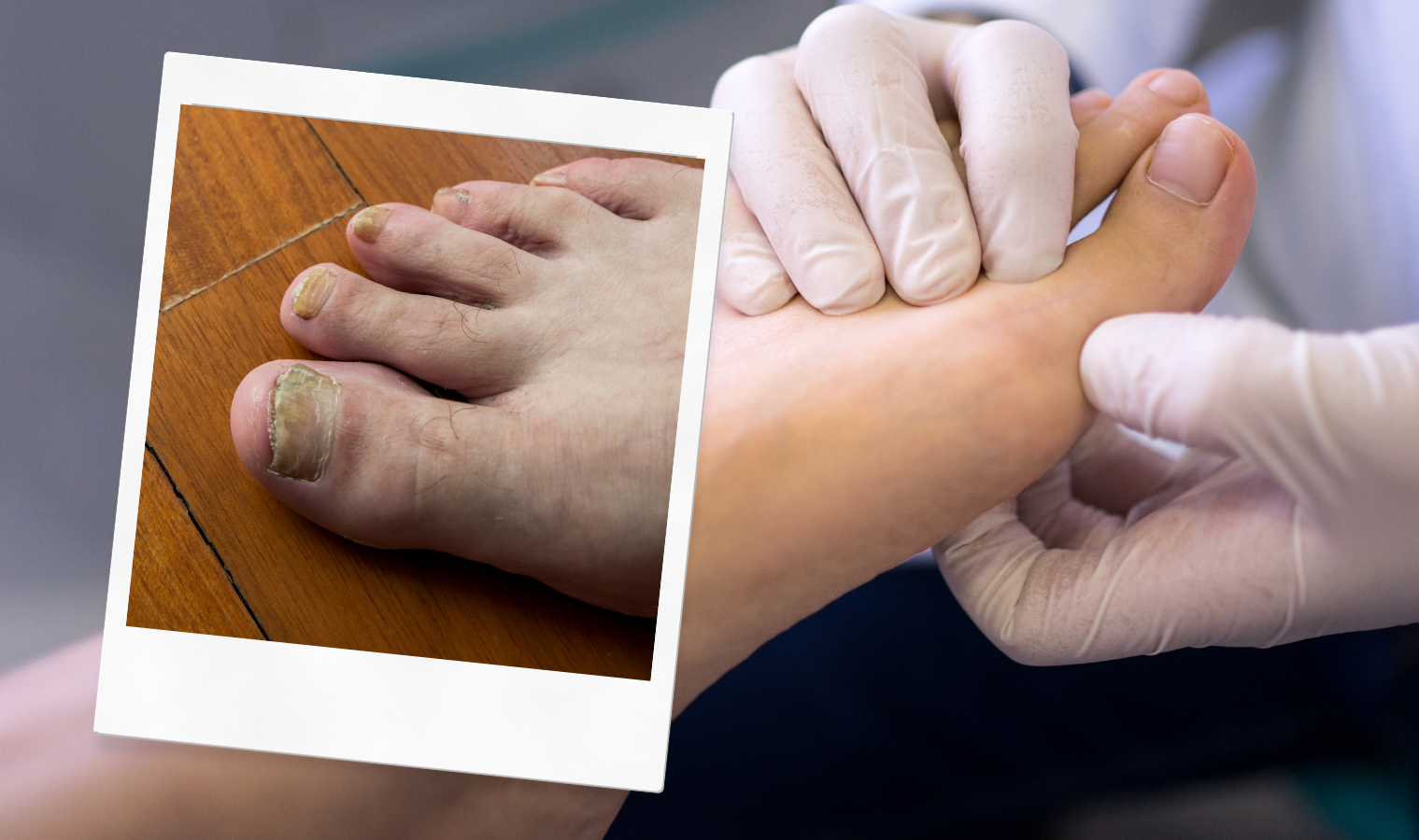 How to Prevent Fungal Nails: Simple Foot Care Tips from a Cambridge ...